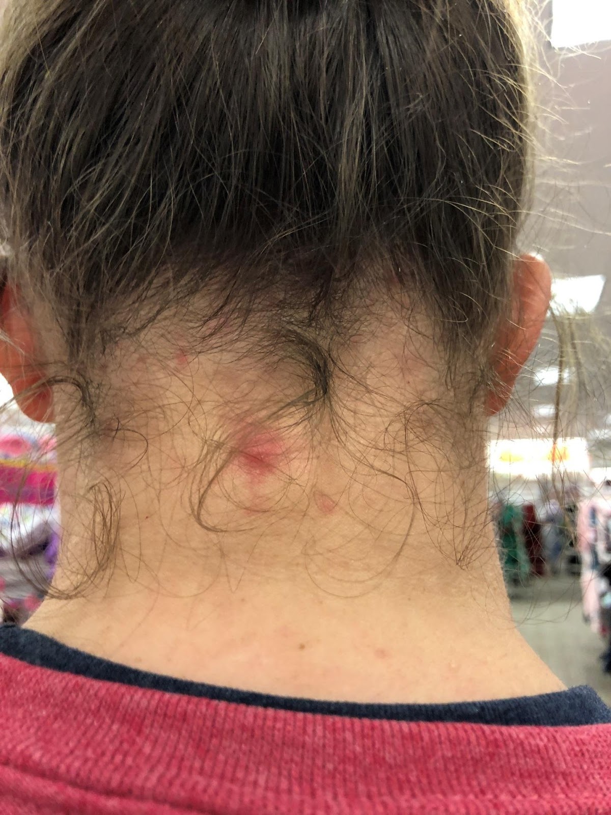 Louse Bites Louse Bites